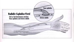 Hämodialyse – Dialysezentrum